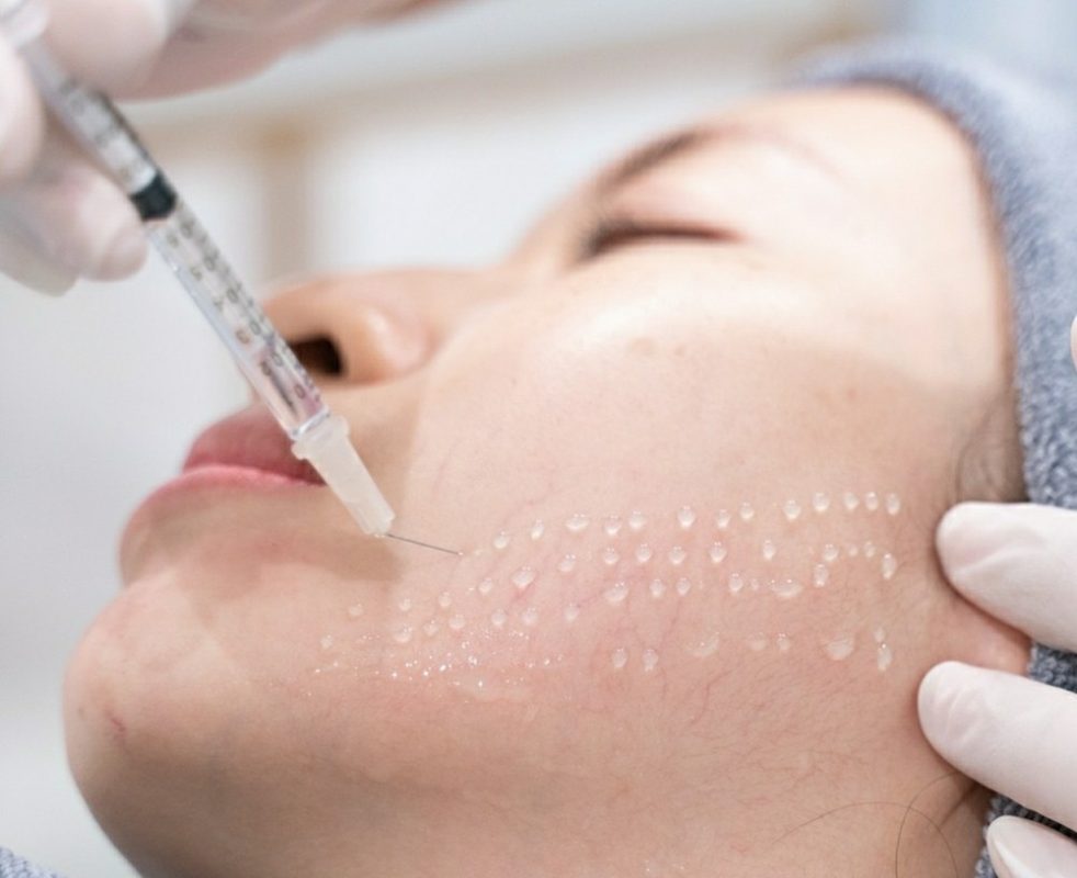 Trẻ Hóa Mesotherapy Là Gì? Làm Meso ở đâu Tốt?