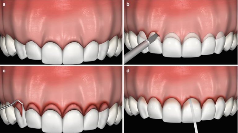 GUMMY SMILE TREATMENT - CROWN LENGTHENING VS. GUM CONTOURING